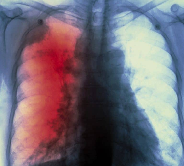 Roche lung cancer drug Alecensa gets rapid US approval - Pharmafile